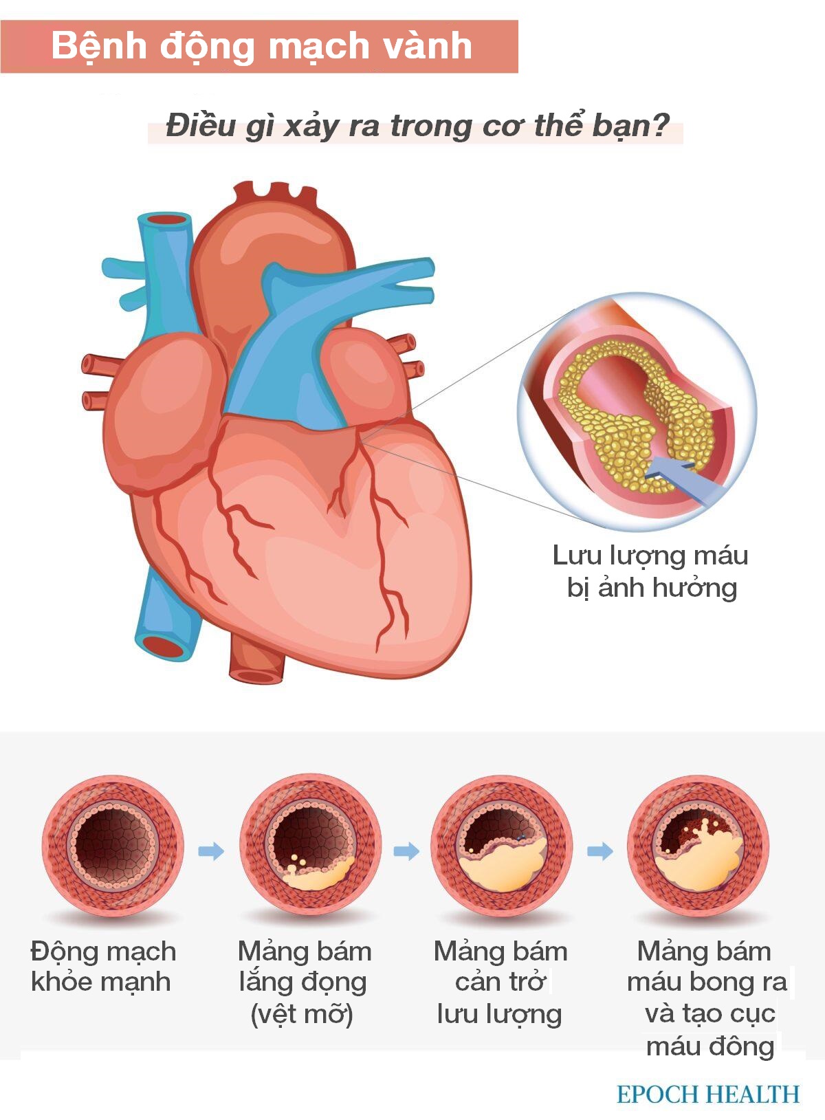 Hướng dẫn cơ bản về bệnh tim: Triệu chứng, nguyên nhân, điều trị và các ...