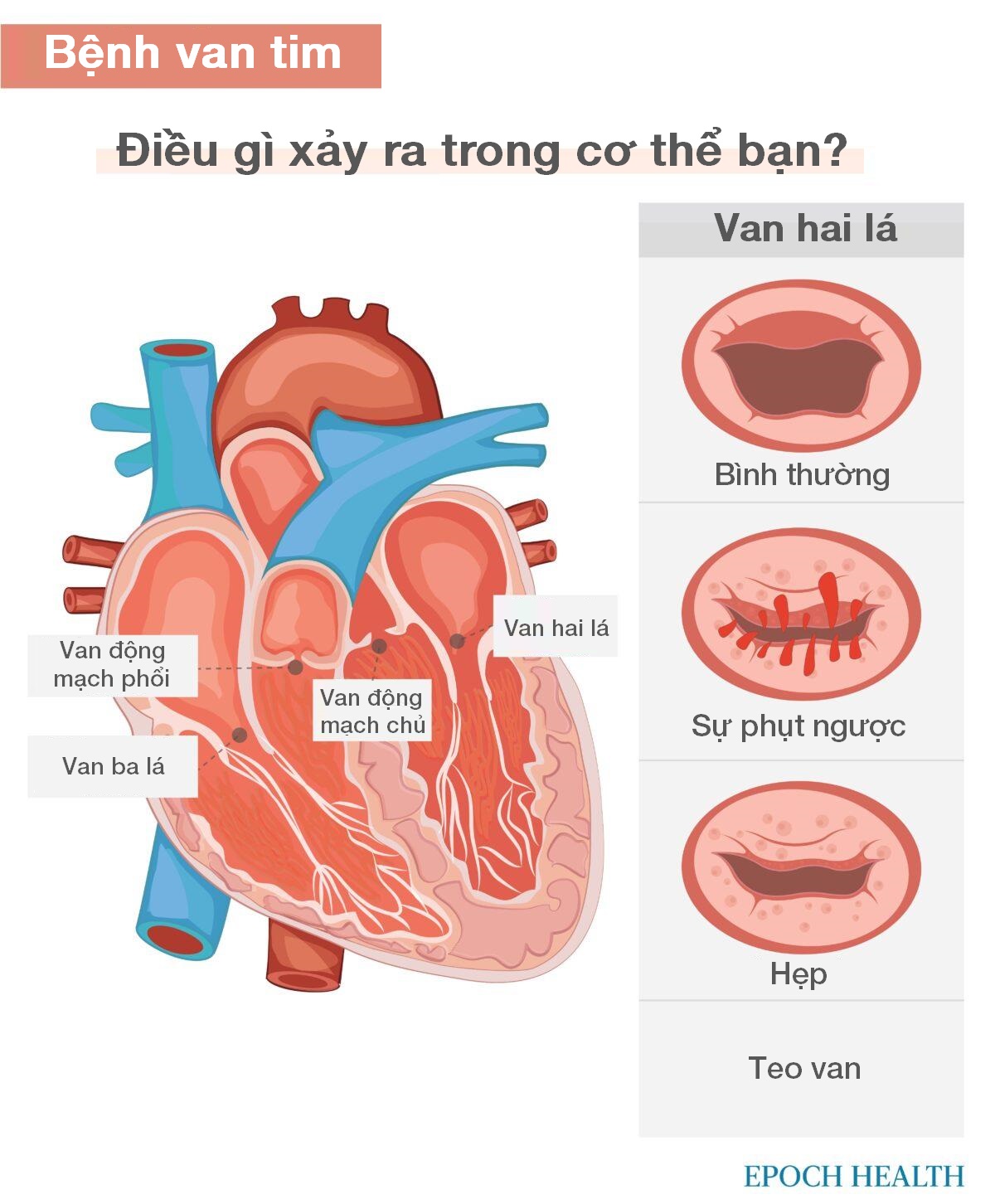 Hướng dẫn cơ bản về bệnh tim: Triệu chứng, nguyên nhân, điều trị và các ...
